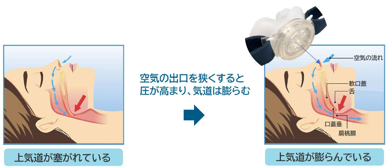 医療用鼻腔拡張器 いびき対策 睡眠時無呼吸症 OPTIPILLOWS オプティピローズ EPAP MASK イーパップ マスク 一般医療機器 ...